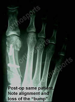 Hallux Valgus (Bunions), Orthosports Orthopaedic Surgeons