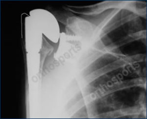 Reverse Shoulder Replacement, Orthosports Orthopaedic Surgeons