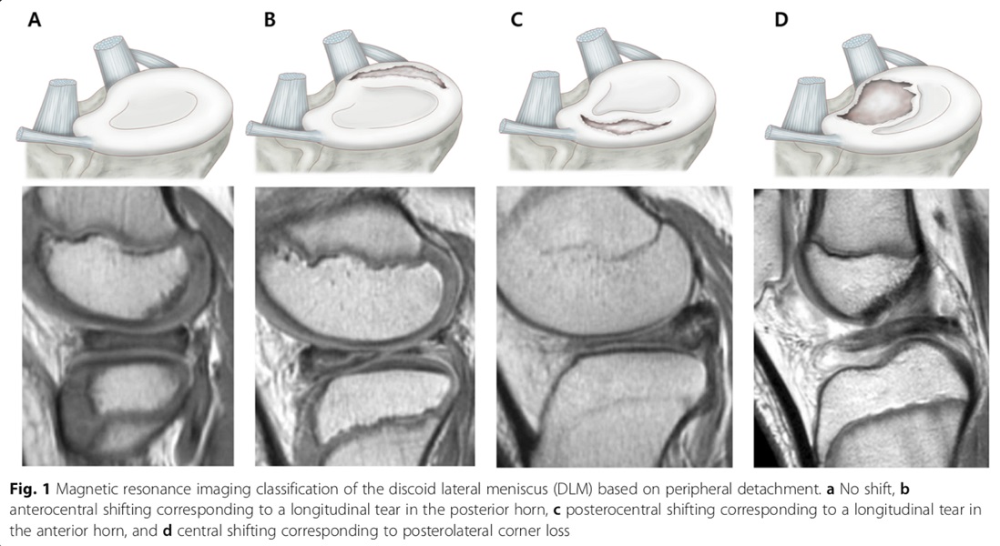 Discoid Lateral Meniscus - Orthosports