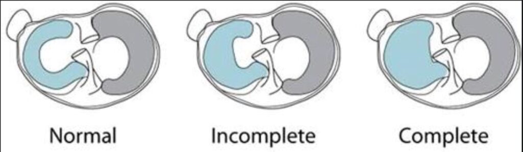 Discoid Lateral Meniscus - Orthosports