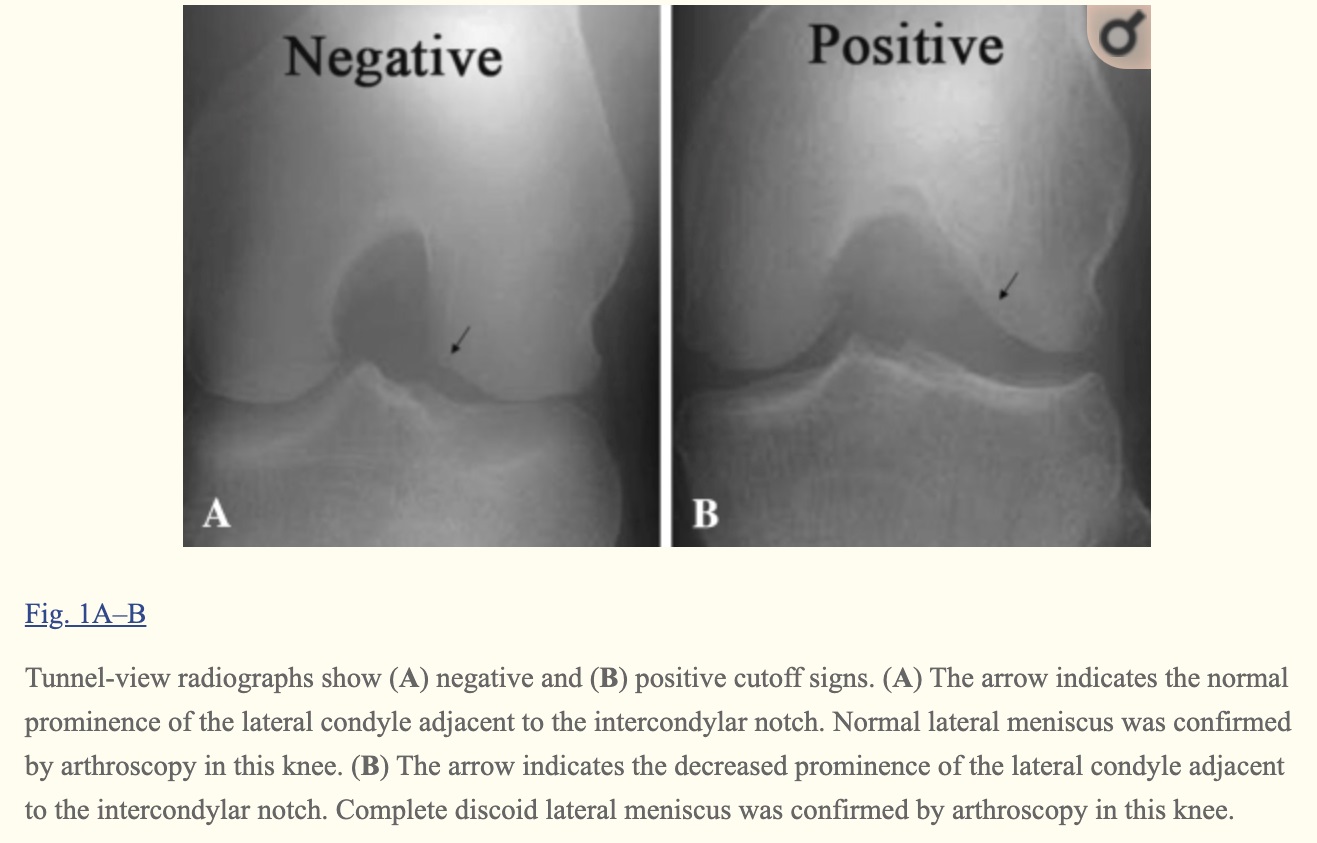 Discoid Lateral Meniscus - Orthosports