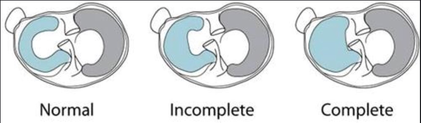 Discoid Lateral Meniscus - Orthosports