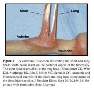Distal Biceps Rupture - Orthosports
