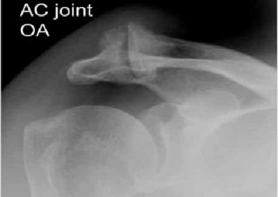 Acromioclavicular Joint Osteoarthritis - Orthosports
