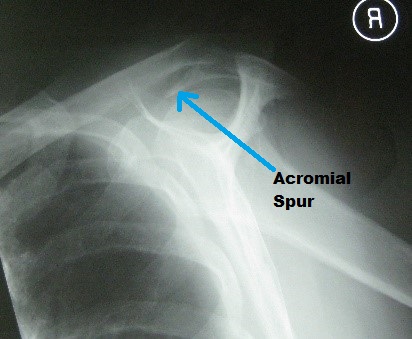 Shoulder Impingement / Tendonitis - Orthosports