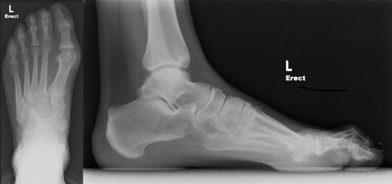 Foot Pain - Orthosports