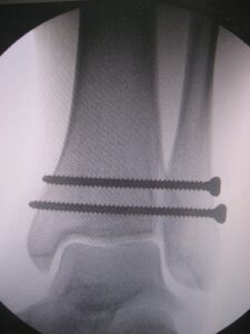 Syndesmosis Fixation - Orthosports