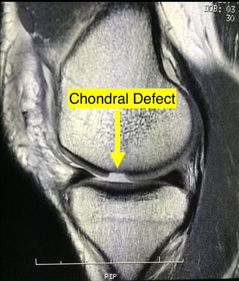 Chondral Grafting in the knee - Orthosports