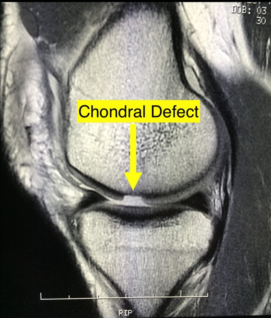 Chondral Grafting in the knee - Orthosports