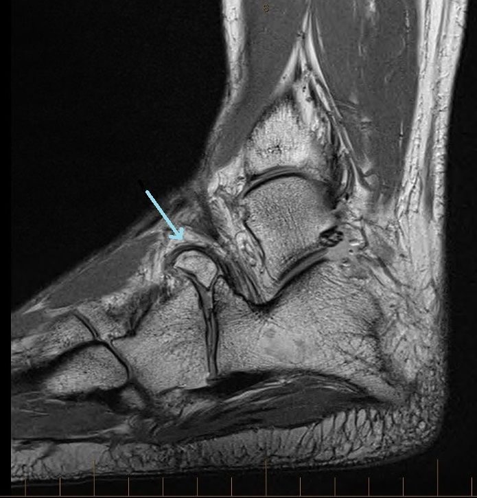 Accessory Bones of the Foot and Ankle - Orthosports