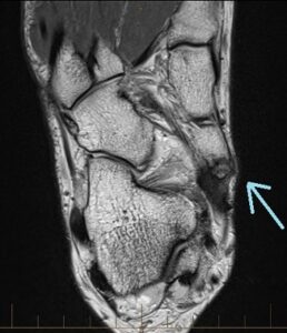 Accessory Bones of the Foot and Ankle - Orthosports