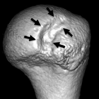 Glenoid Track and Shoulder Instability - Orthosports