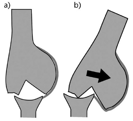 Glenoid Track and Shoulder Instability - Orthosports