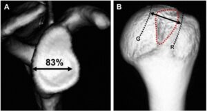 Glenoid Track and Shoulder Instability - Orthosports