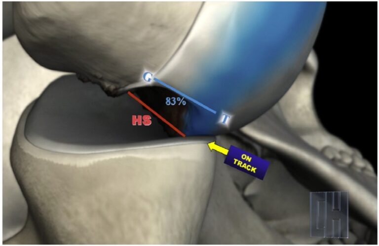 Glenoid Track and Shoulder Instability - Orthosports