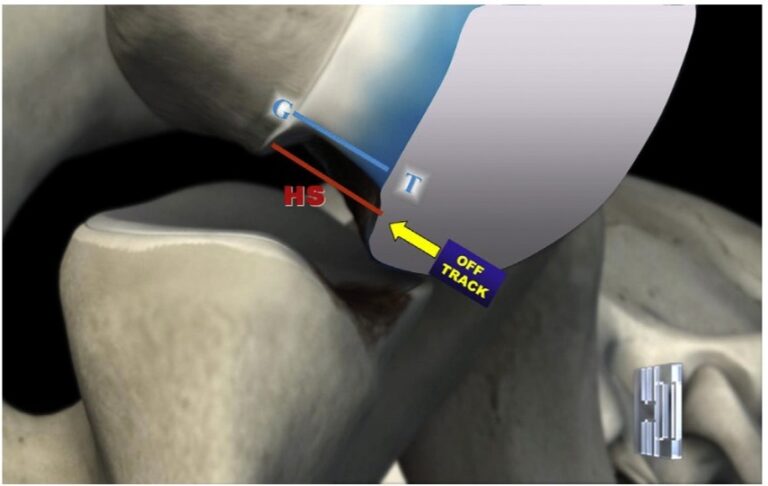 Glenoid Track and Shoulder Instability - Orthosports