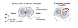 Lateral extra-articular tenodesis - Orthosports