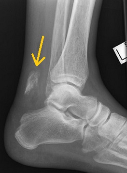 Achilles Tendon Ruptures - Orthosports