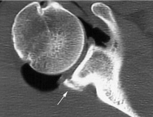 Internal Impingement of the Shoulder - Orthosports