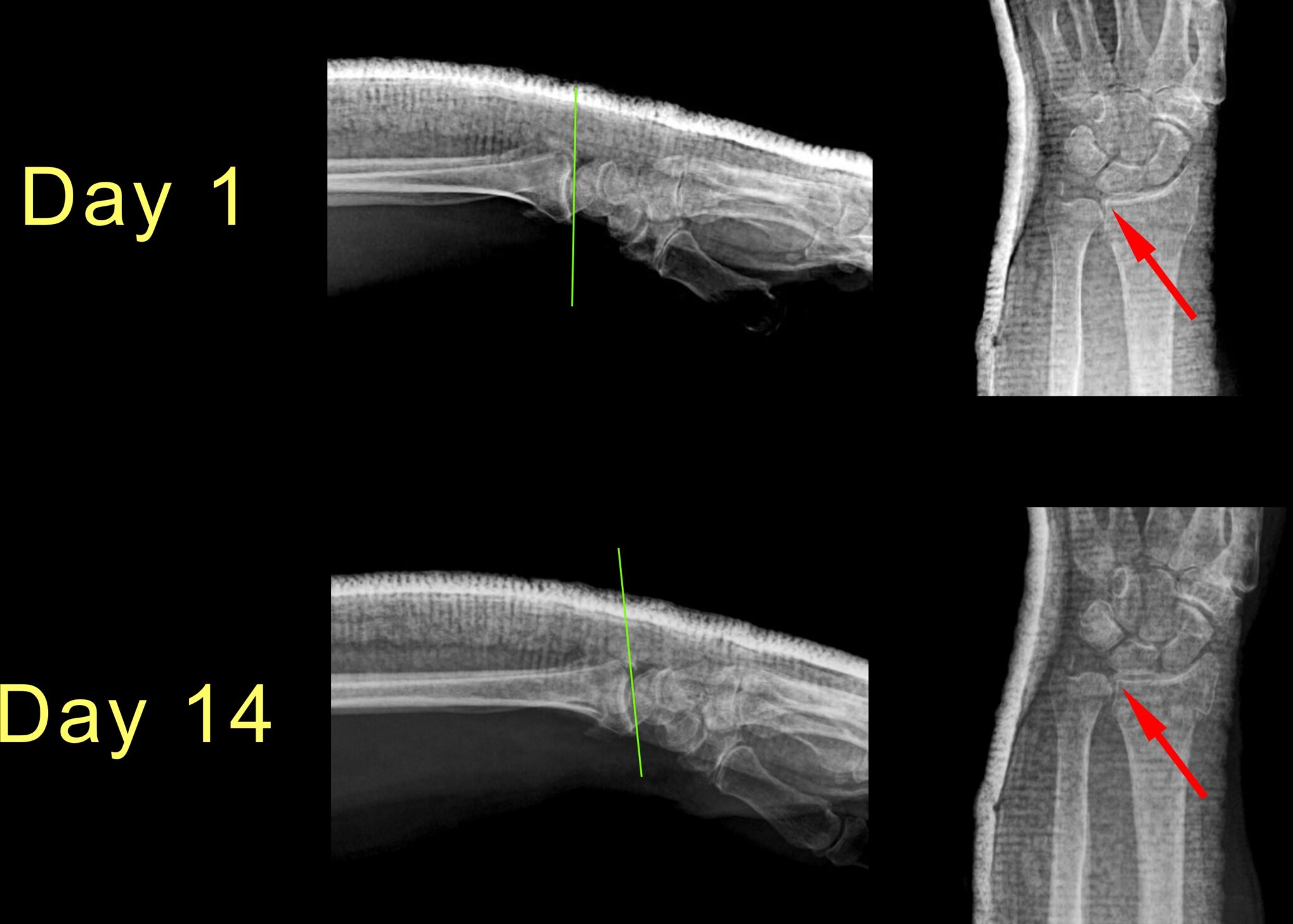 Wrist Fracture Xrays - Orthosports